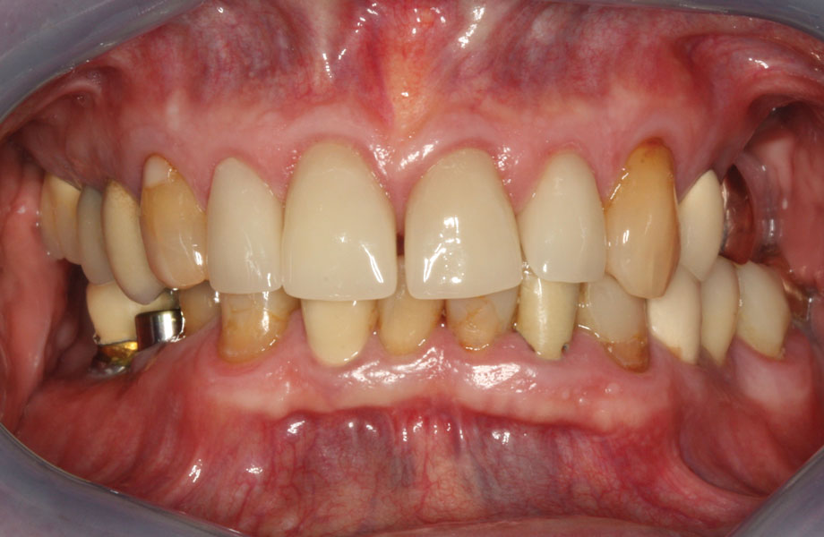 When Single-Tooth Dentistry Falls Short | Inside Dental Technology