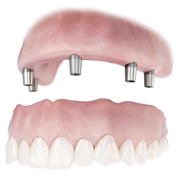 The Truth About Friction-Retained Hybrid Prostheses | Inside Dental ...
