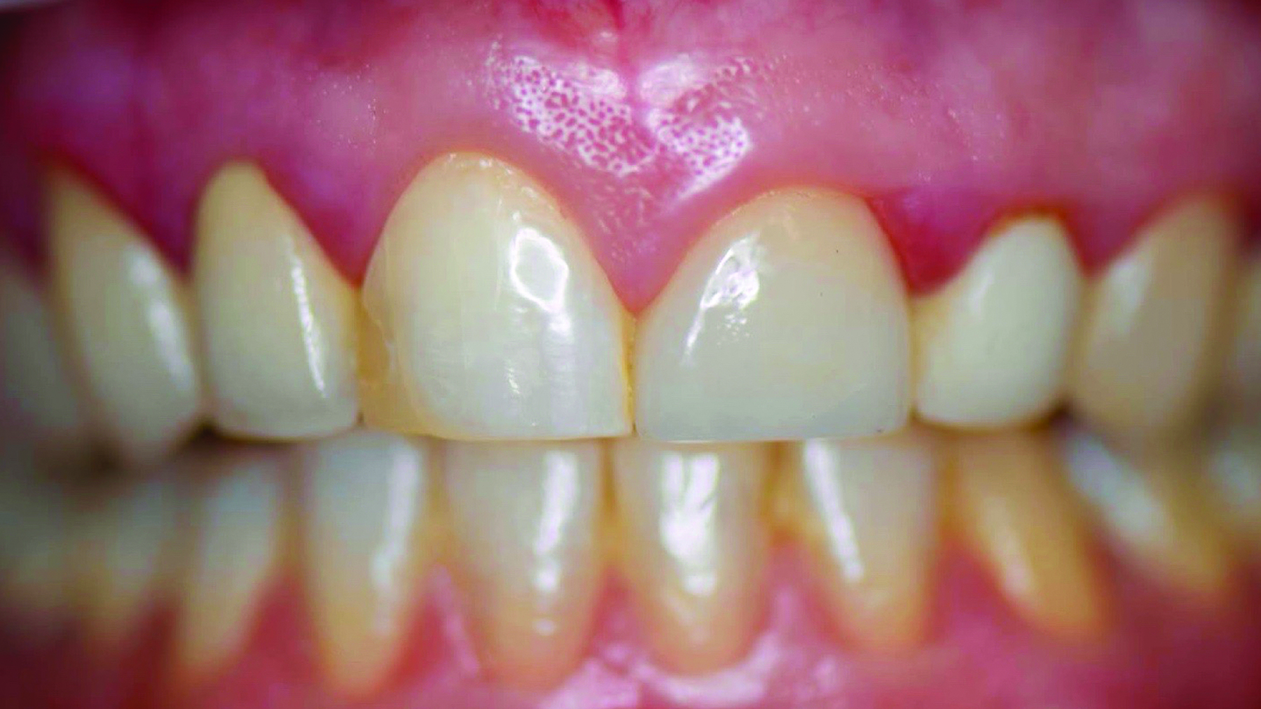 Esthetic Rehabilitation of the Patient with Attrition | Inside Dental ...