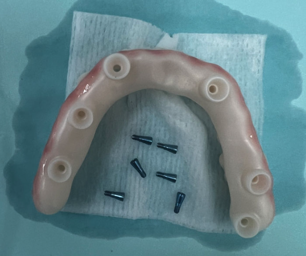Improving Screw-Retained Prosthetics With Elimination of Ti Bases ...