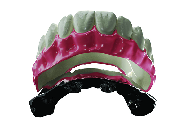 Revolutionizing Full-Arch Restorations | Inside Dental Technology
