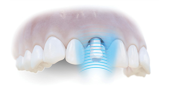 Intraoral Scanning for ATLANTIS Abutments | Inside Dental Technology
