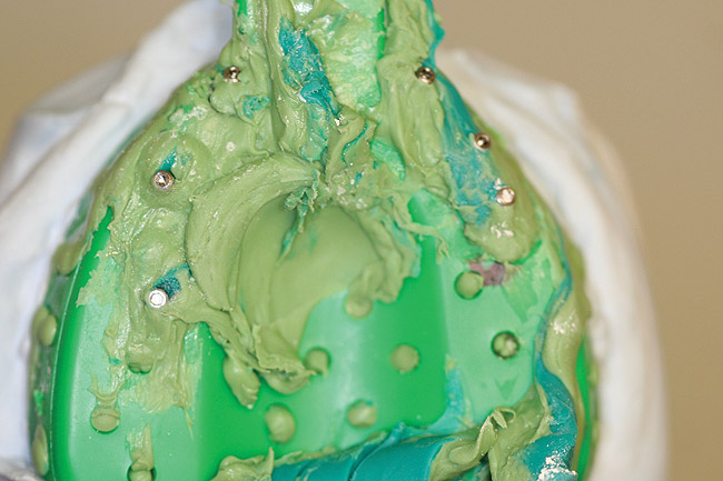 Full-Arch Restorations on CAD/CAM-Milled Titanium Bars | Inside Dental ...