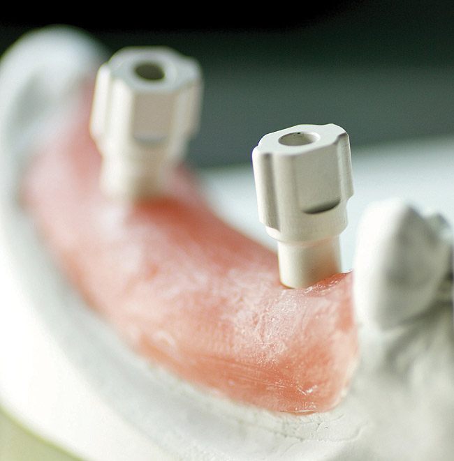 The 2-CONnect Bridge | Inside Dental Technology