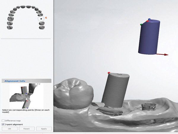 CAD/CAM Technology in Implant Abutment Design | Inside Dental Technology