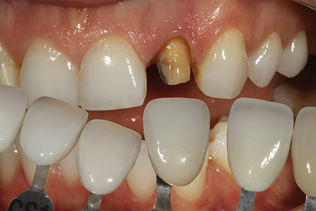 Custom Shade-Matching Made Simple | Inside Dental Technology