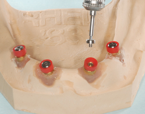 OT CAP Spherical and EQUATOR Threaded Attachments | Inside Dental ...