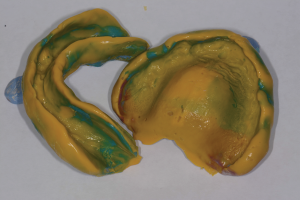 Conus Abutments: a Fixed, Hygienic, Restorative Solution | Inside ...