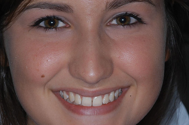 No-Preparation Veneers to Enhance the Natural Tooth | Inside Dental ...