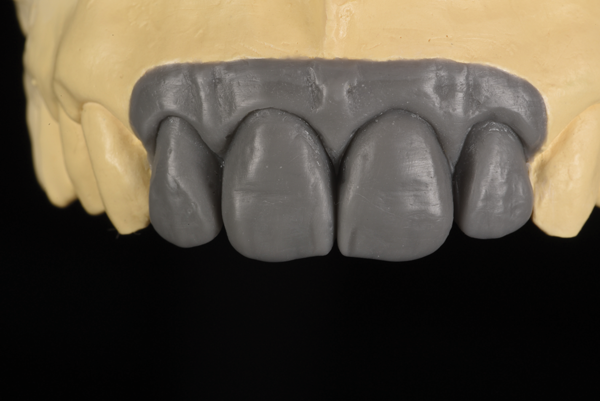 Esthetic Substructures | Inside Dental Technology