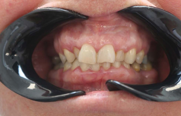 Immediate Dentures Based on Digital Impressions and Digital Workflow ...