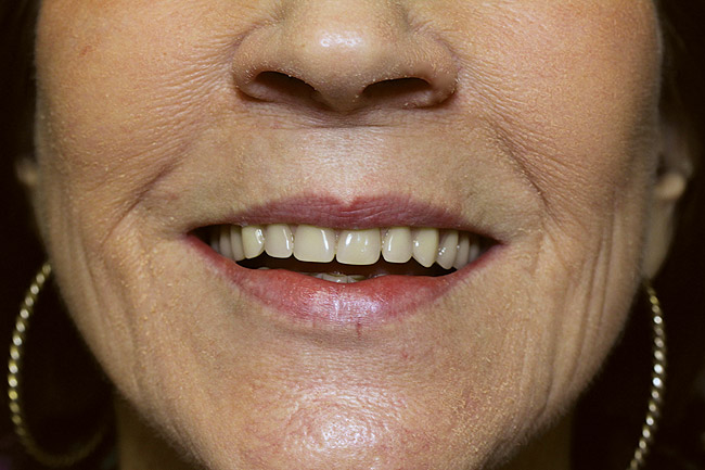 Creating a Custom Denture Base Plate | Inside Dental Technology