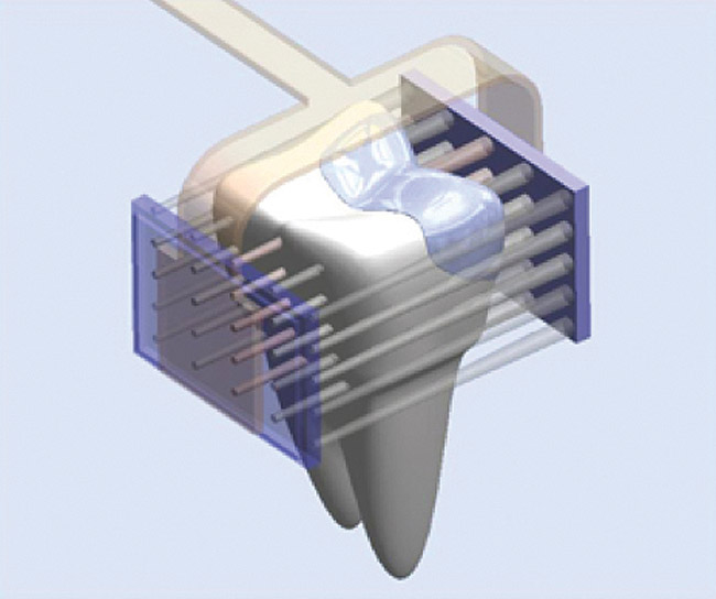 Digital Impression Technology | Inside Dental Technology