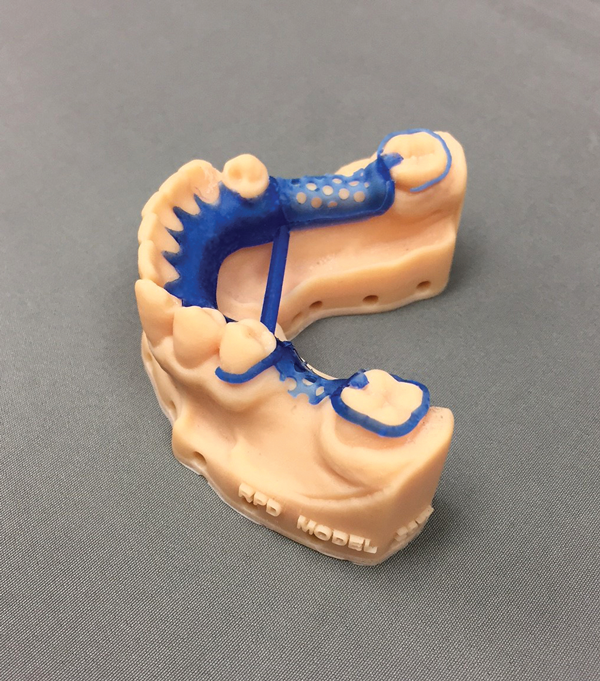 Casting Printed Removable Partial Denture Frames in Seven Steps ...
