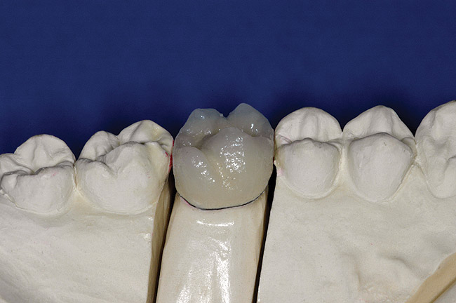 Don’t Forget the Basics | Inside Dental Technology
