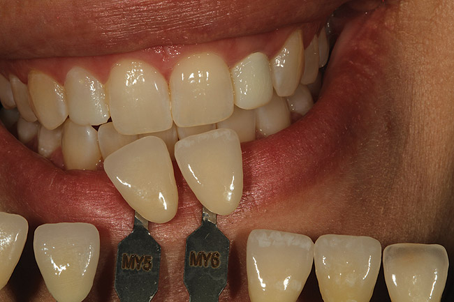 Creating Beautiful Results with Platinum Foil | Inside Dental Technology