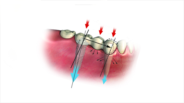 Versatility in Dental Implants and Prostheses | Inside Dental Technology