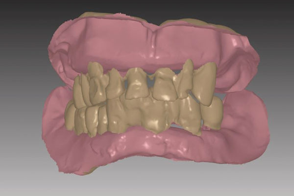 Digital Denture Diagnostics | Inside Dental Technology
