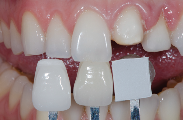 Accurate Shade Analysis and Communication | Inside Dental Technology