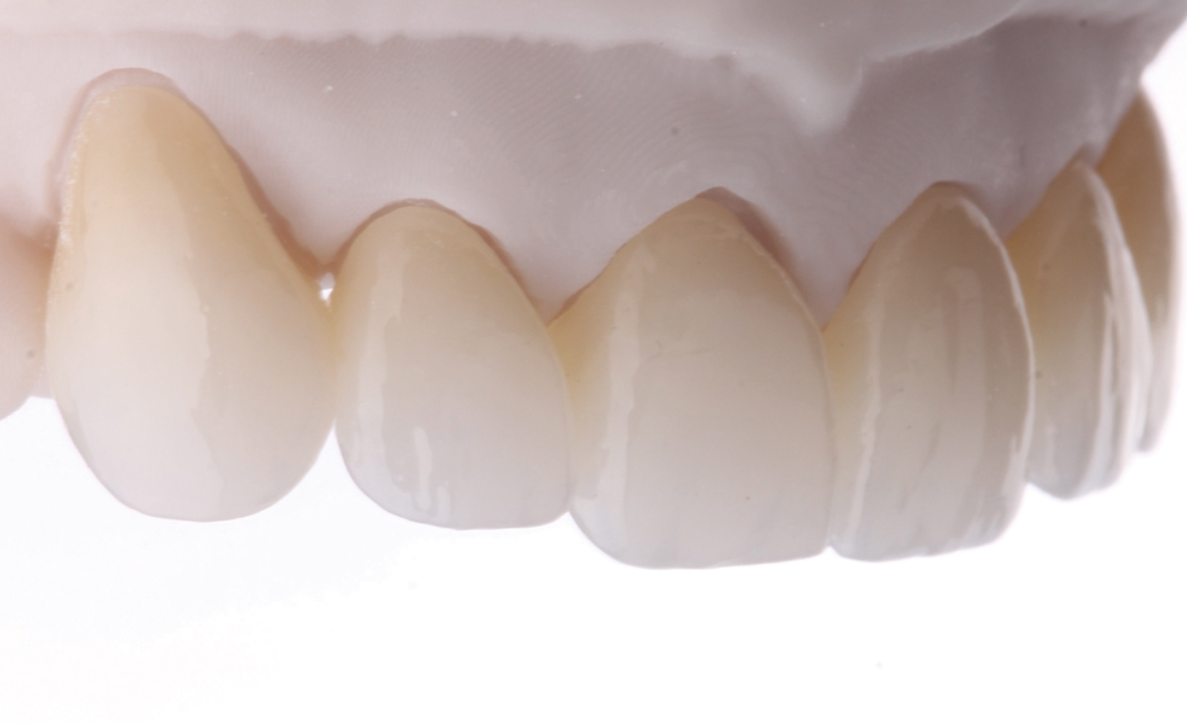 Improving Anterior Esthetics with All-Ceramic Restorations | Inside ...