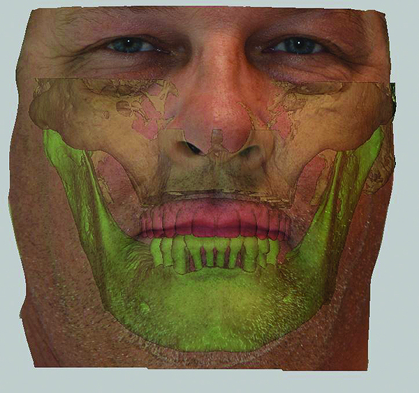 The Virtual Dental Patient: Digitally Designed All-On-X | Inside Dental ...