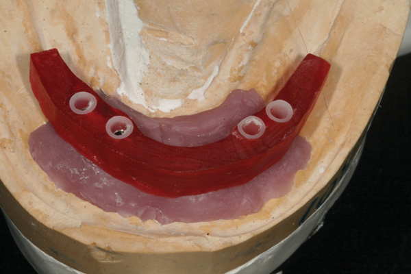 Milled Bar Overdentures-Protocol and Procedures | Inside Dental Technology