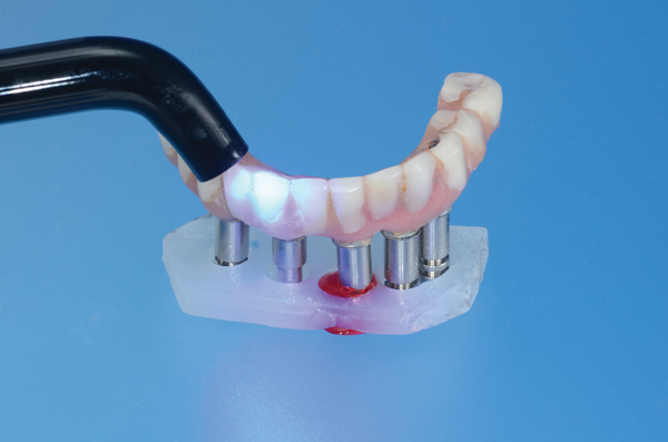 The Metal-Zirconia Implant Fixed Hybrid Full-Arch Prosthesis | Inside ...