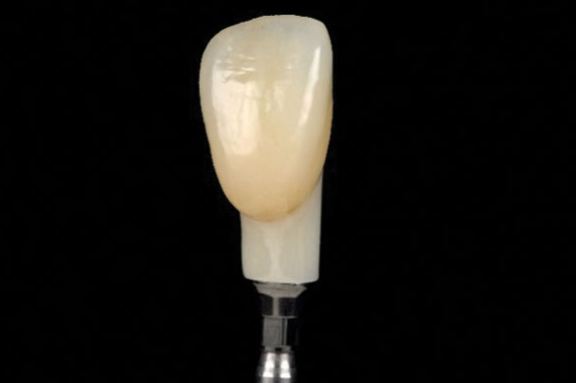 Anterior Tooth Replacement in an Adolescent With a High Smile Line ...