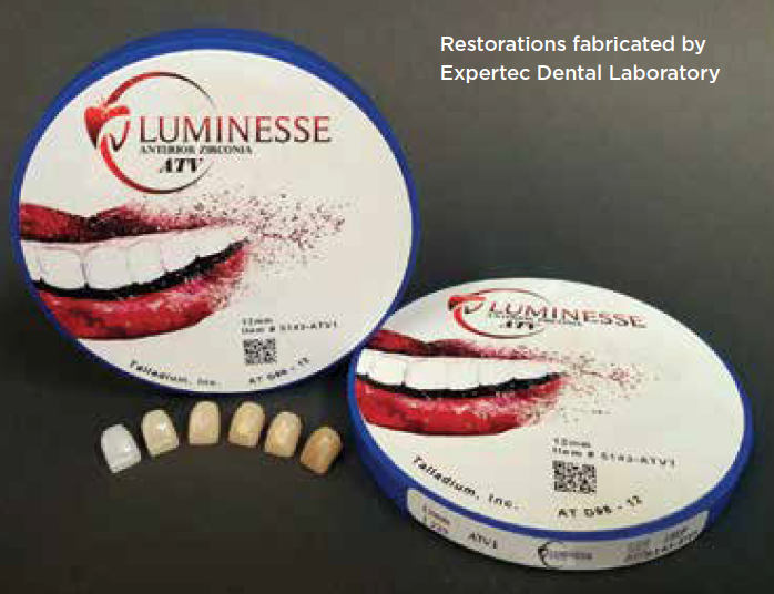 Luminesse ATV Offers Premium Esthetics Efficiently | Inside Dental ...