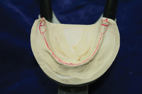 The Denture Setup | Inside Dental Technology