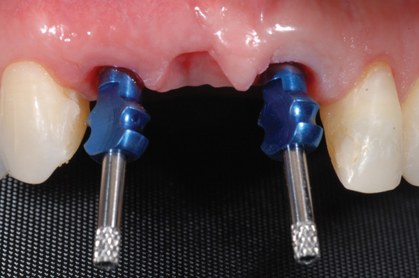 Techniques for Accurate Impressions of the Peri-Implant Soft Tissue ...
