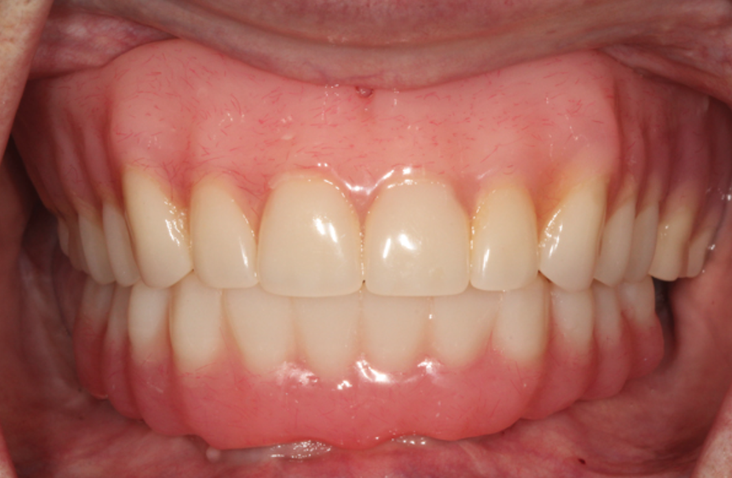 A Screw-Free Fixed Hybrid Prosthesis in Two Visits | Inside Dental ...