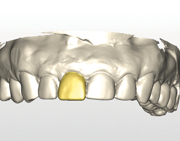 SIMPLANT® + ATLANTIS™ = Immediate Smile® | Inside Dental Technology