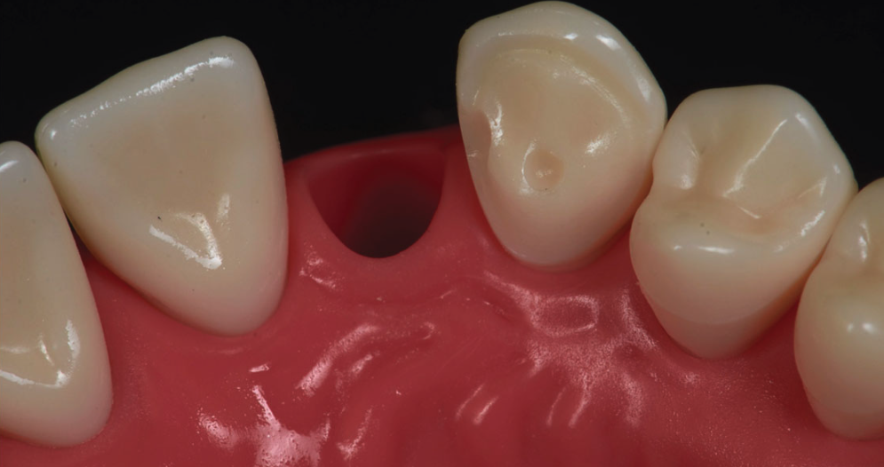 The Bonded Single-Wing Zirconia Bridge | Inside Dental Technology