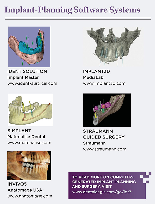 Digital Implant Planning Software | Inside Dental Technology