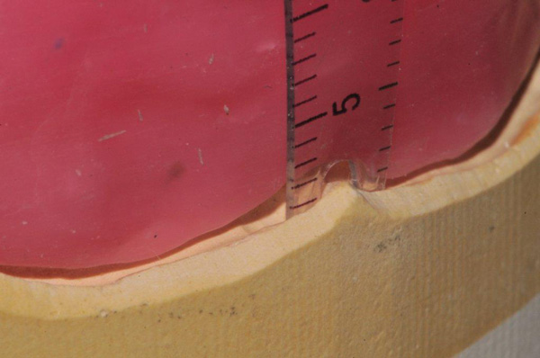 PalaMeter® Measuring Instrument | Inside Dental Technology