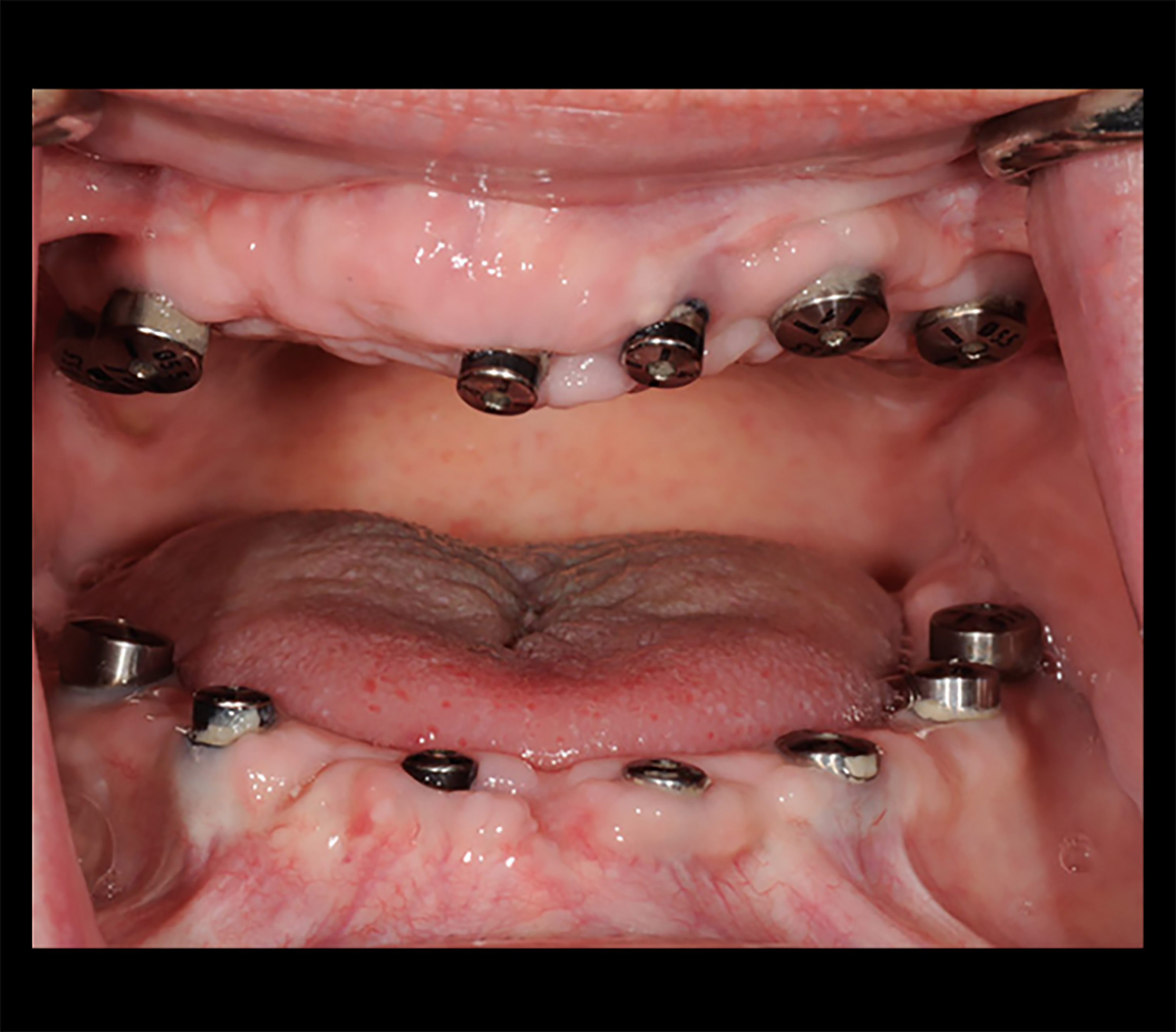 Prosthodontic Protocols for Fixed Hybrid Implant Restorations | Inside ...