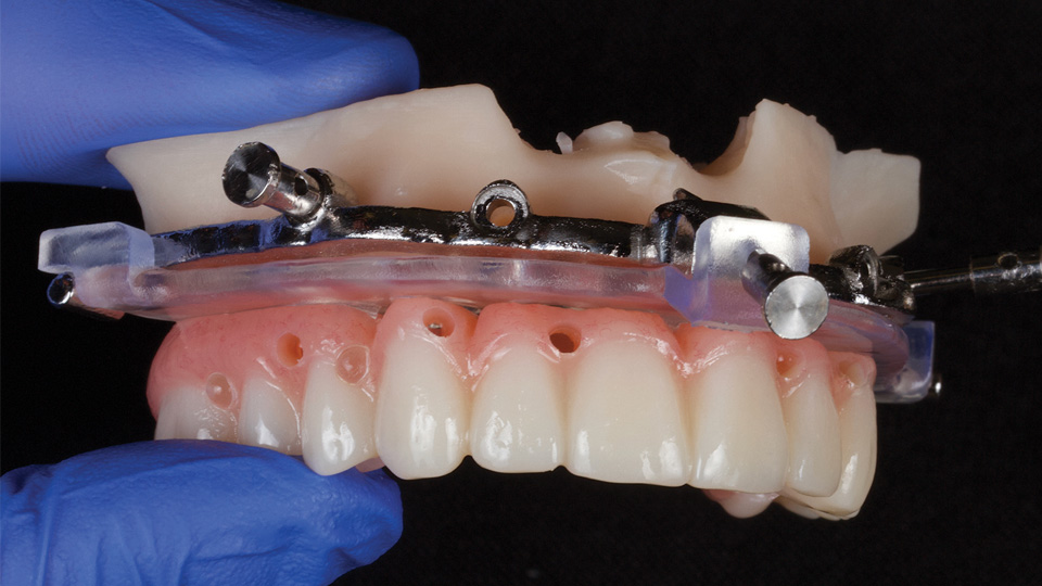 Digital Workflow for a Definitive Implant-Supported Hybrid Prosthesis ...