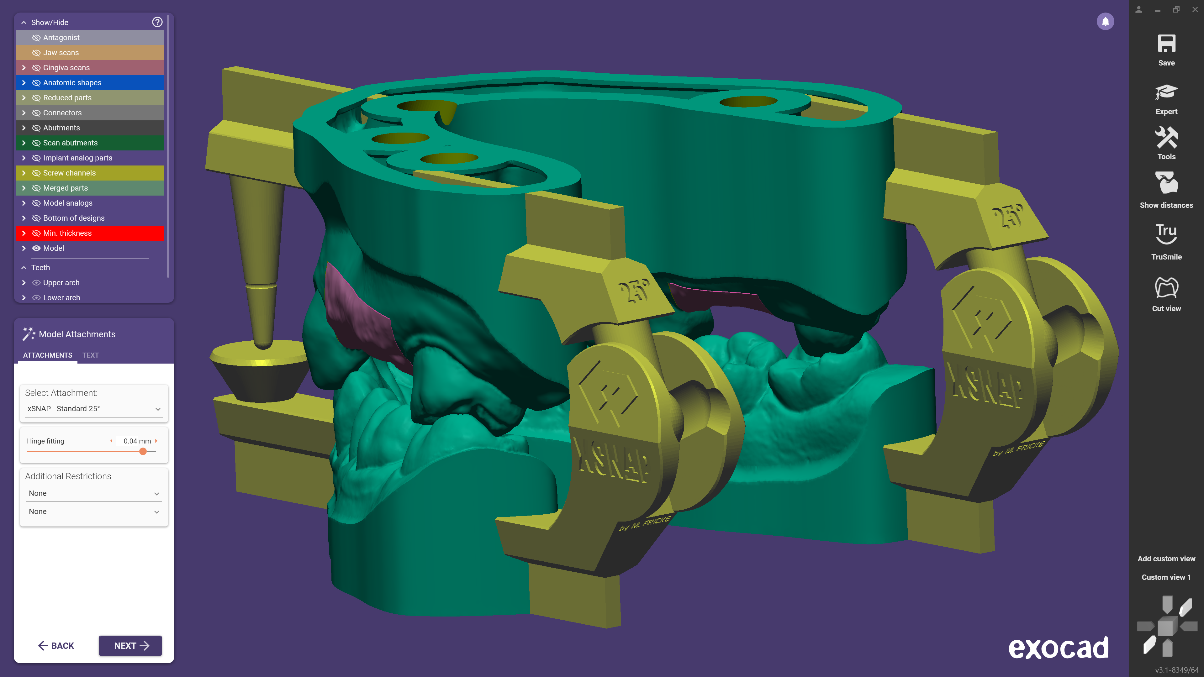 xSNAP Is exocad’s New Add-On Module For Printable Articulators | Inside ...