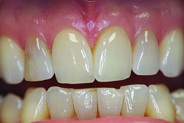 Utilizing Pressable Ceramics for a Cosmetic Anterior Case: Part II ...