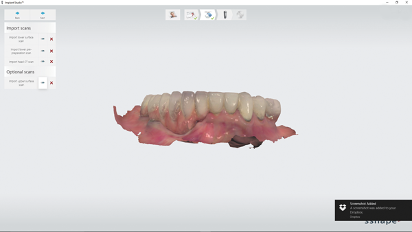 Implant Placement Planning and Surgical Guide Design | Inside Dental ...