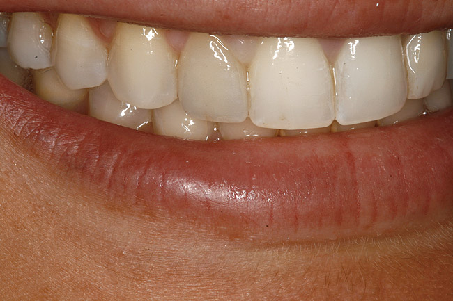 Maximum Custom Shade Matching for Laterals | Inside Dental Technology