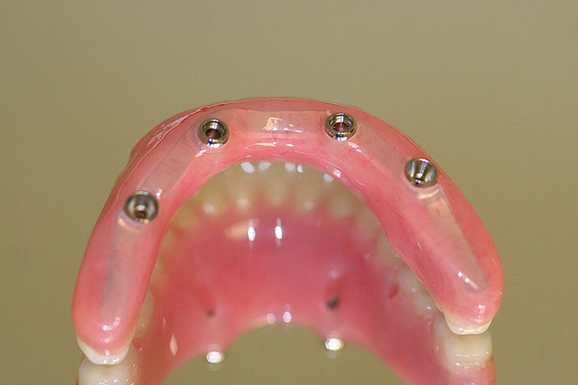 Full-Arch Restorations on CAD/CAM-Milled Titanium Bars—Part II | Inside ...